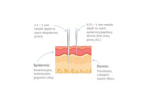 SkinPen Microneedling - The Beauty and Cosmetic Clinic @ 70 Pitt St