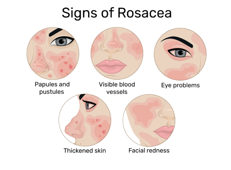 A Novel Approach to Facial Rosacea - The Beauty and Cosmetic Clinic ...